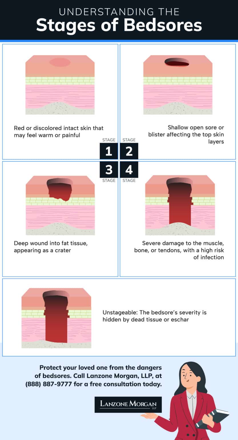 Bedsore Stages | Complete Guide & Graphics | Lanzone Morgan, LLP