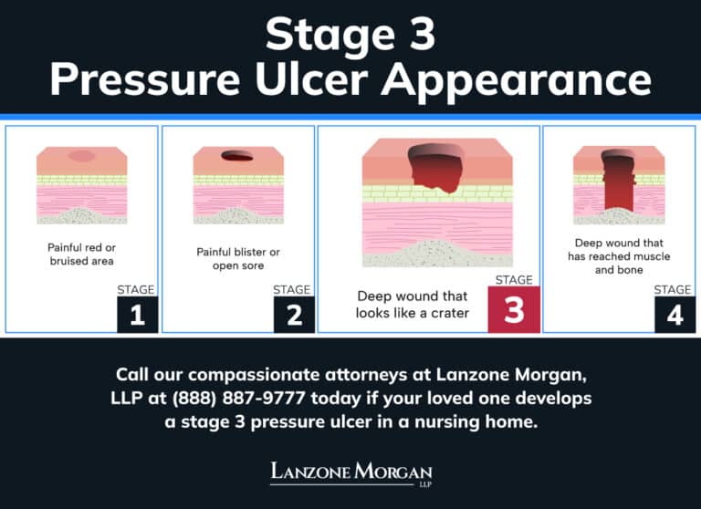 Stage 3 Bedsore | Symptoms, Causes, Treatment