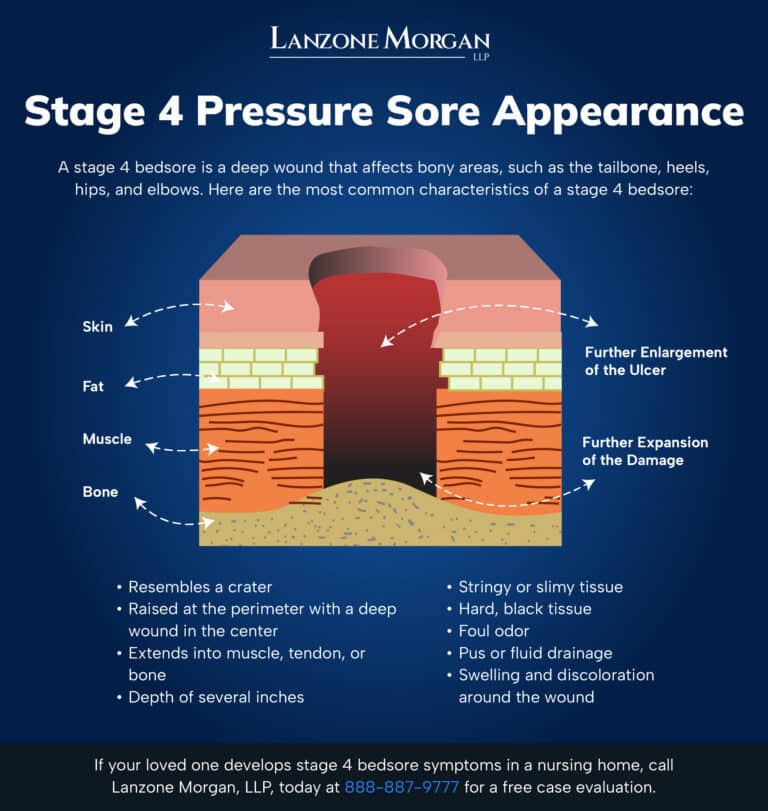 Stage 4 Bedsore | Symptoms, Complications, Pictures